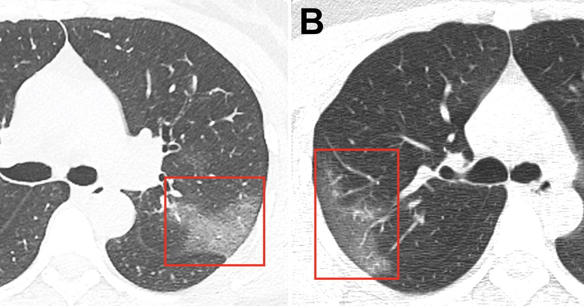 Rendgen snimak pluća koji pokazuje šta koronavirus radi plućima čoveka ...