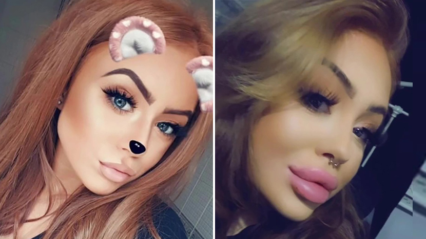 Već 4 godine ubrizgava hijaluron u usne: "Kažu da sam preterala, ali ja ...