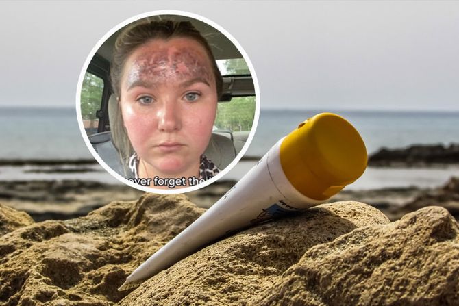 "Namazala sam kremu za sunčanje kojoj je istekao rok i dobila opekotine ...