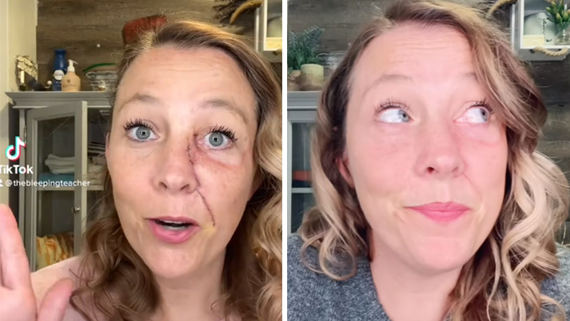 Tačka na licu je bila rak kože - Telegraf.rs