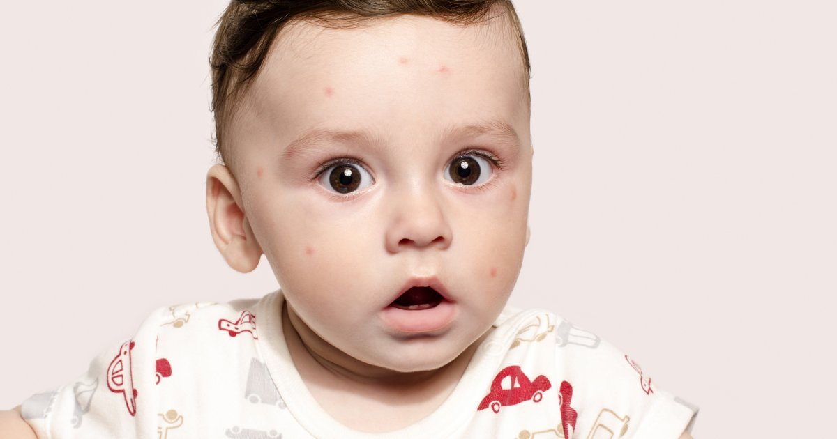 Dr Rsovac: Postoji opasnost od epidemije morbila, teži oblici velikog ...