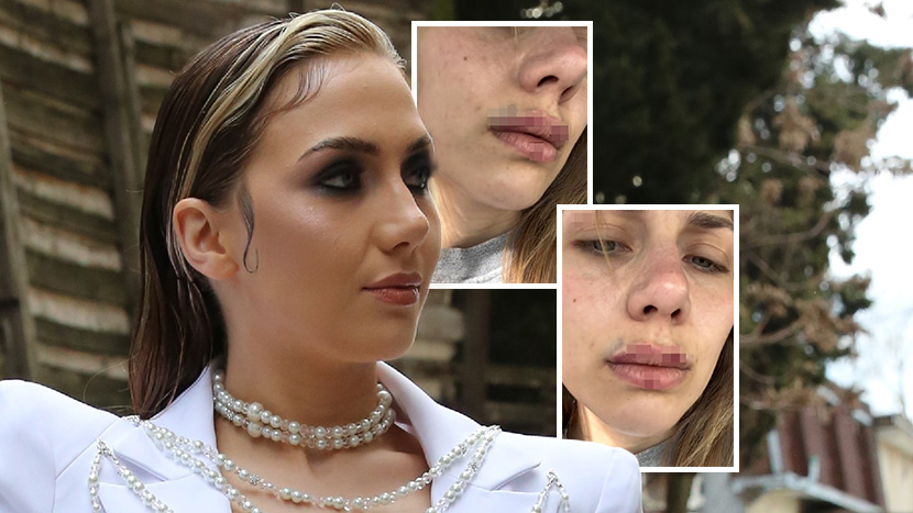 Zorja Pajić pokazala kako izgleda posle estetskog zahvata - Telegraf.rs