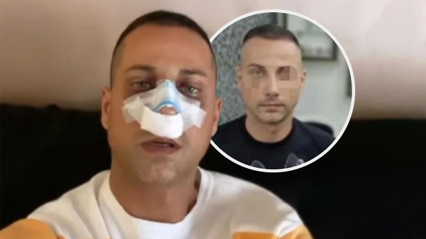 Marko Đedović pokazao novi nos - Telegraf.rs