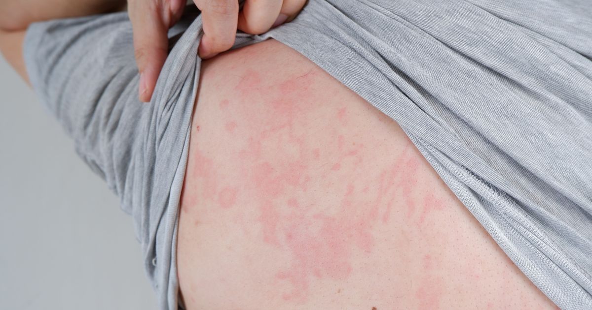 Šuga se širi po Crnoj Gori: Najviše obolelih u Podgorici - Naslovi.net