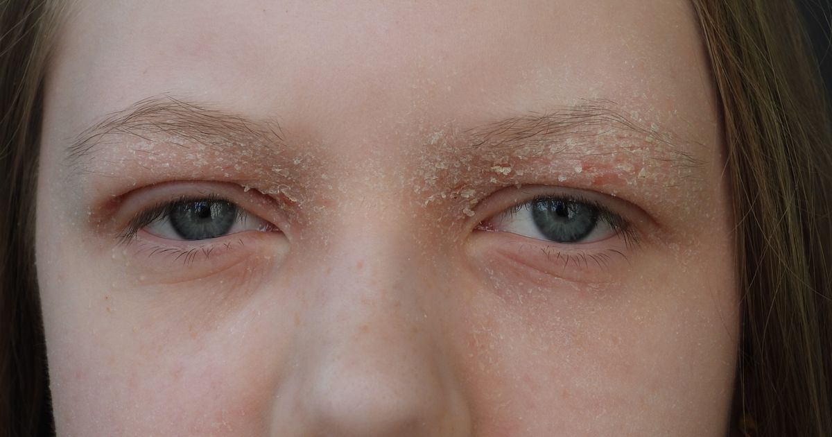 Devojčica ima težak ekcem da je postala alegrična na svoje suze i znoj ...