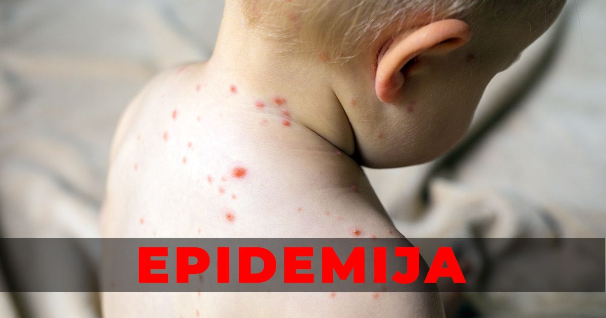 Prijavljena epidemija malih boginja u Beogradu - Vesti - Telegraf.rs