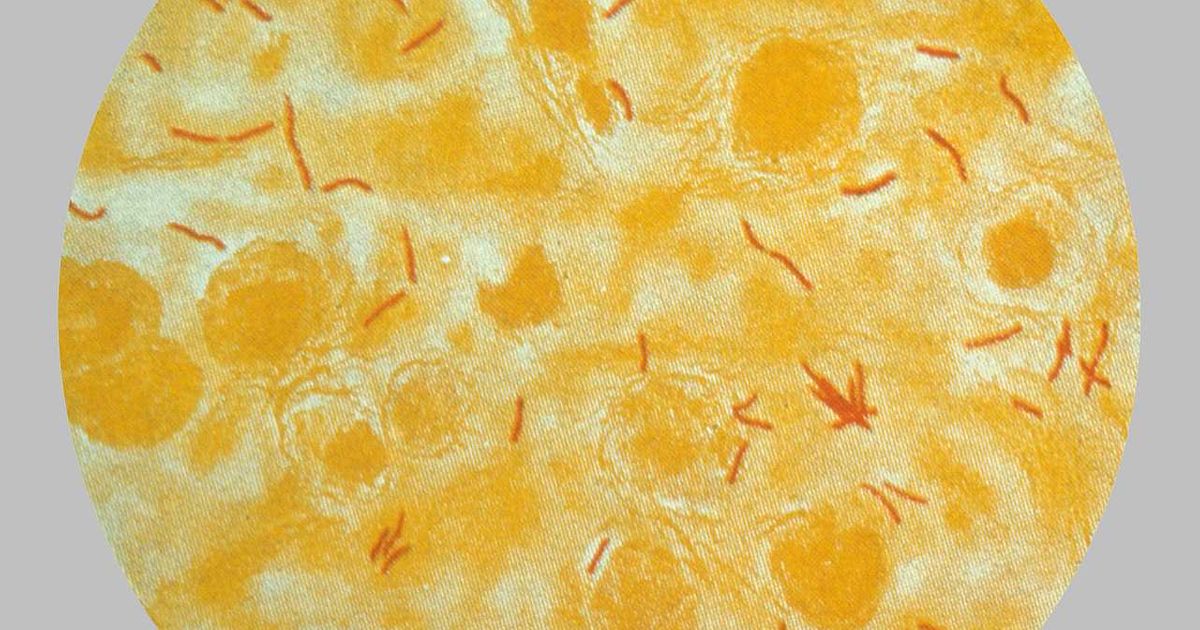 Nova klasifikacija tuberkuloze u cilju eliminisanja ove bolesti - Nauka ...