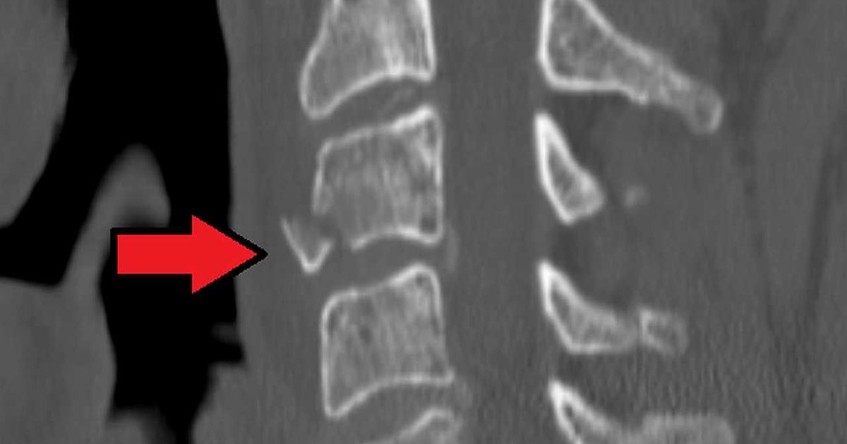 Električni pulsevi sa fizioterapijom mogu ublažiti paralizu nakon ...