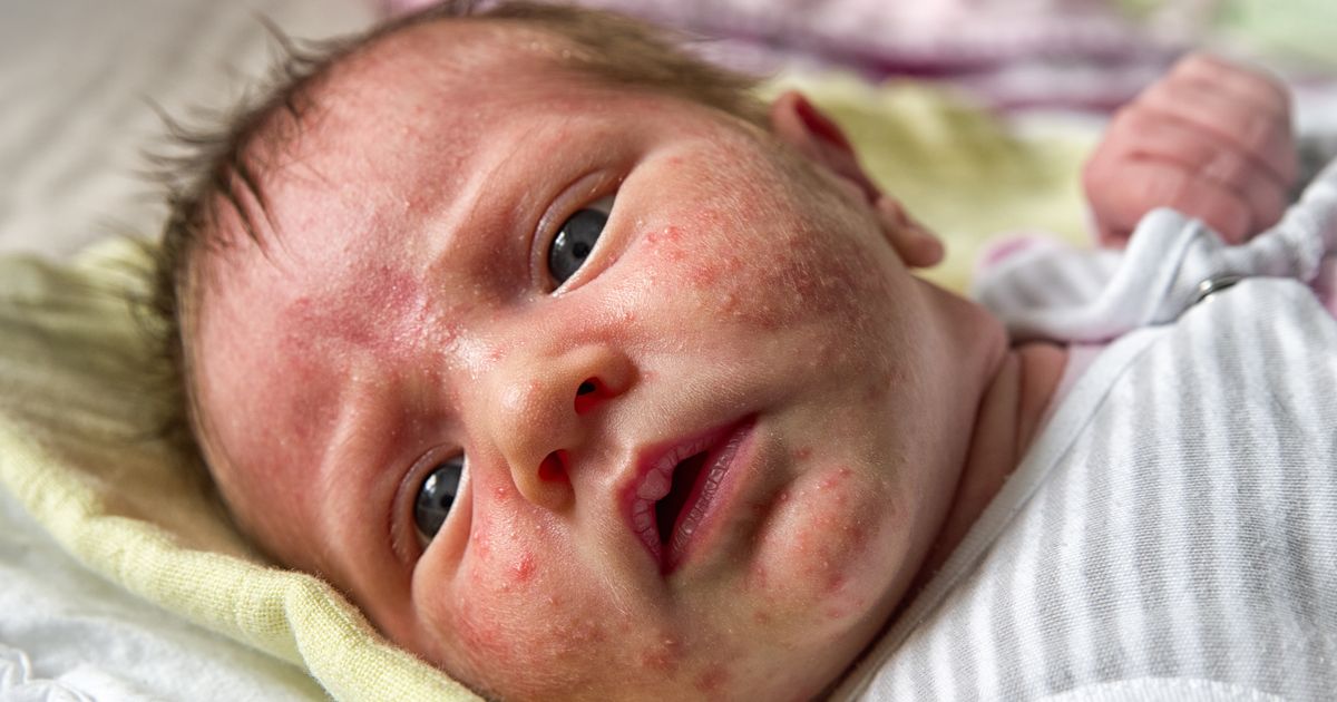 Mama objavila potresnu slike bebe obolele od malih boginja: "Mučio se ...