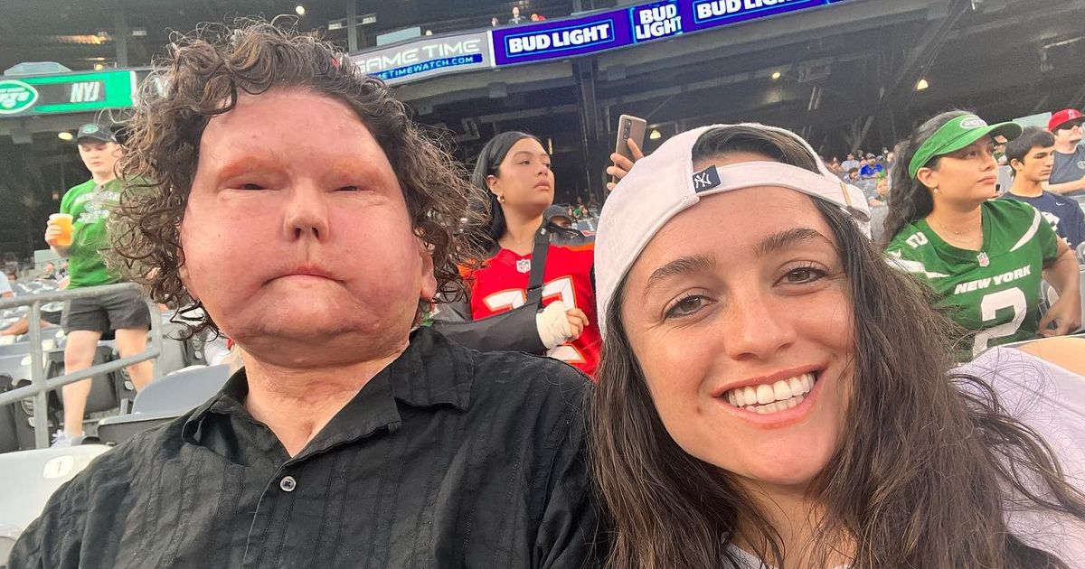 Čovek podvrgnut prvoj transplantaciji lica podelio fotografije sa ...